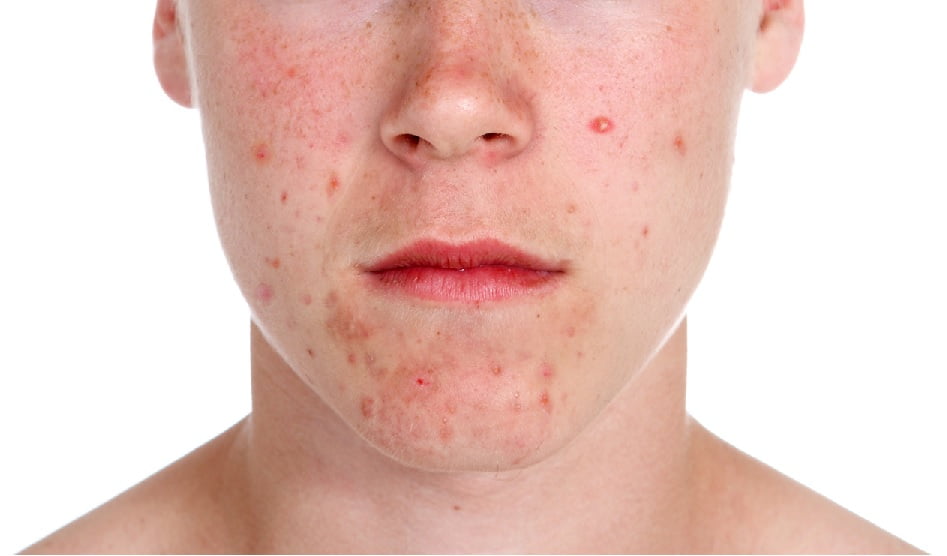 Saiba sobre o tratamento de acne com a luz intensa pulsada